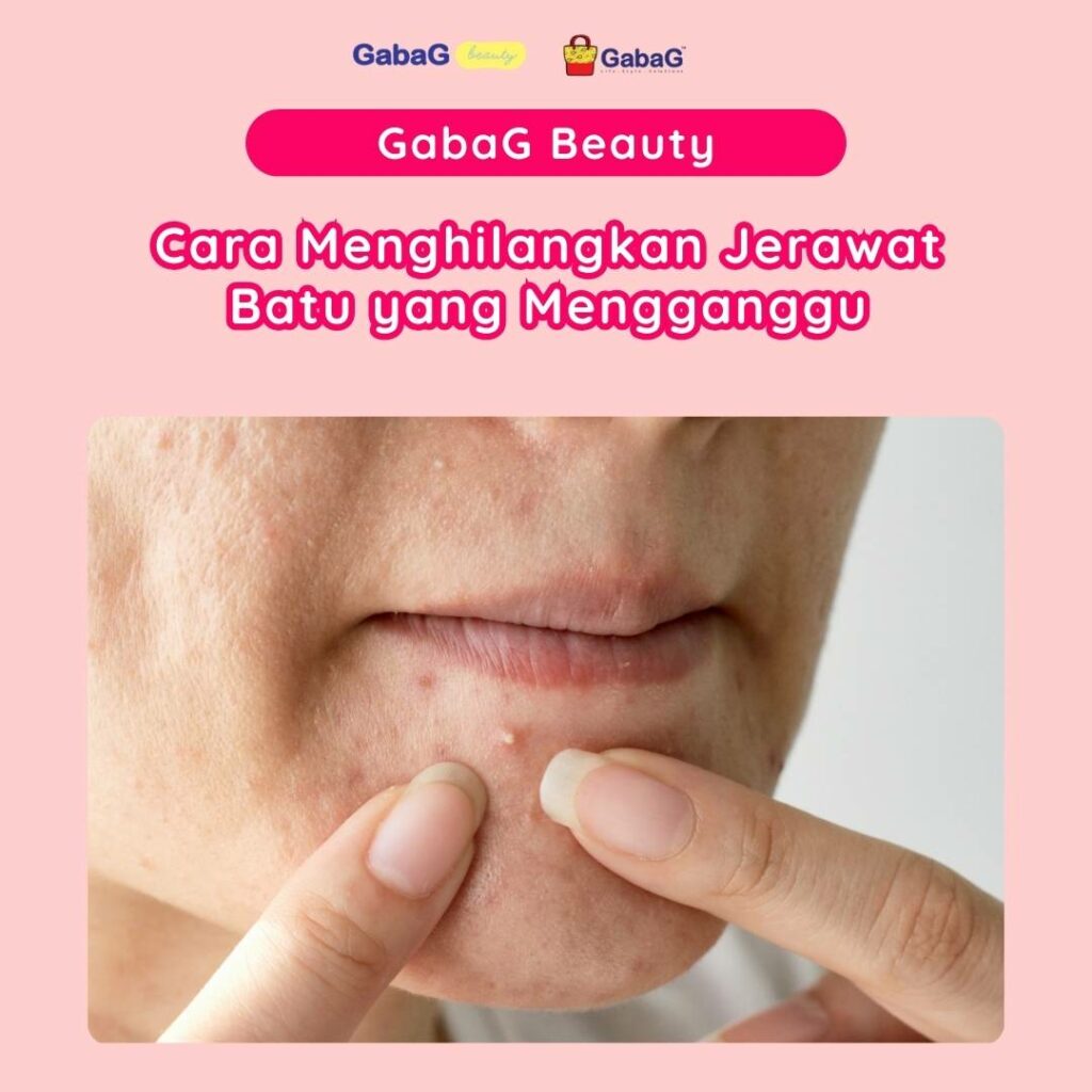 Cara Menghilangkan Jerawat Batu yang Mengganggu - Gabag Indonesia