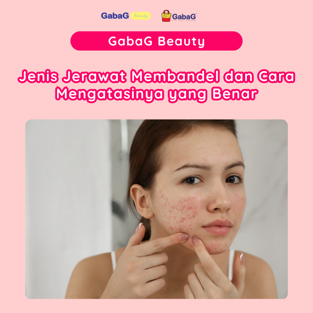 4 Jenis Jerawat Membandel dan Cara Mengatasinya yang Benar - Gabag ...