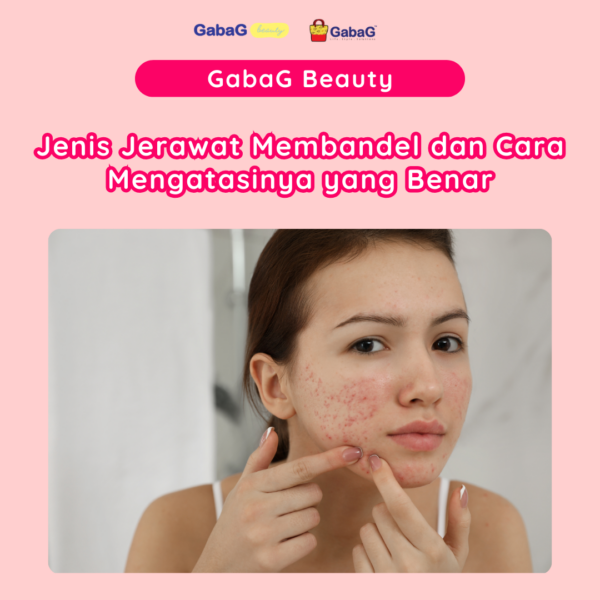 4 Jenis Jerawat Membandel dan Cara Mengatasinya yang Benar - Gabag ...