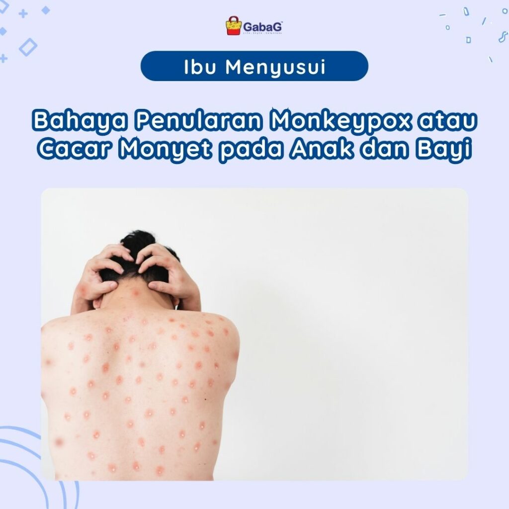 Bahaya Penularan Monkeypox atau Cacar Monyet pada Anak dan Bayi - Gabag ...