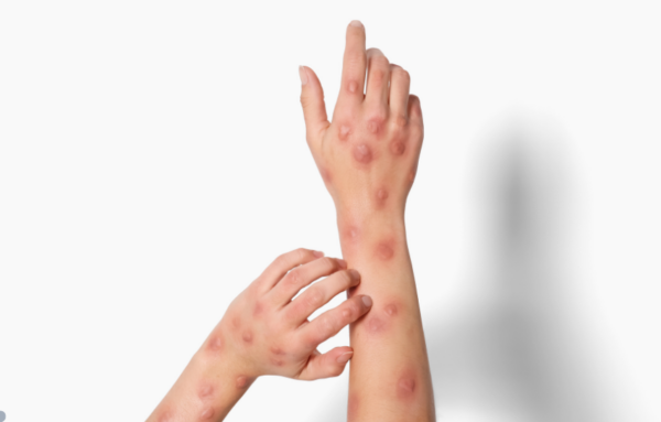 Bahaya Penularan Monkeypox atau Cacar Monyet pada Anak dan Bayi - Gabag ...