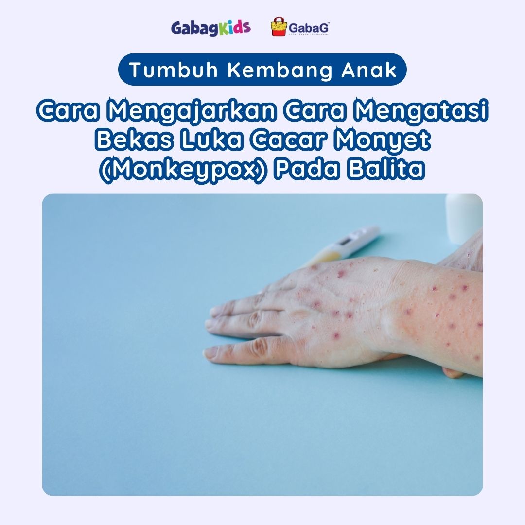 Cara Mengatasi Bekas Luka Cacar Monyet (Monkeypox) - Gabag Indonesia